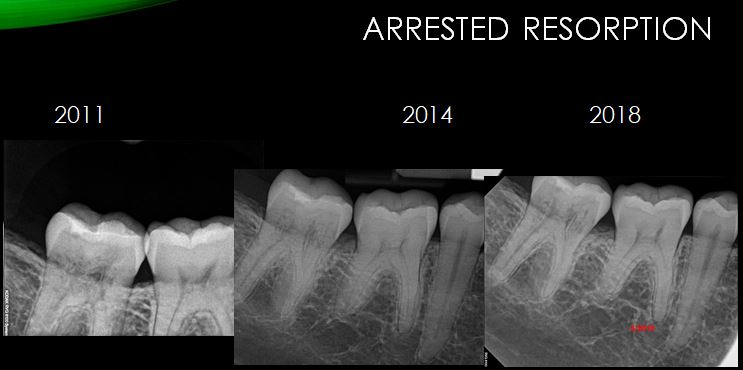 Root Resorption Treatment Rochester MN, Zumbro Valley Endodontics