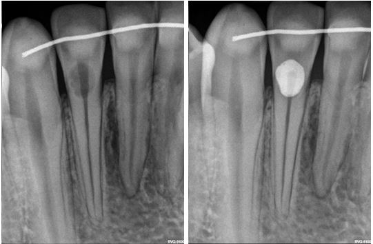 Root Resorption Treatment Rochester MN, Zumbro Valley Endodontics